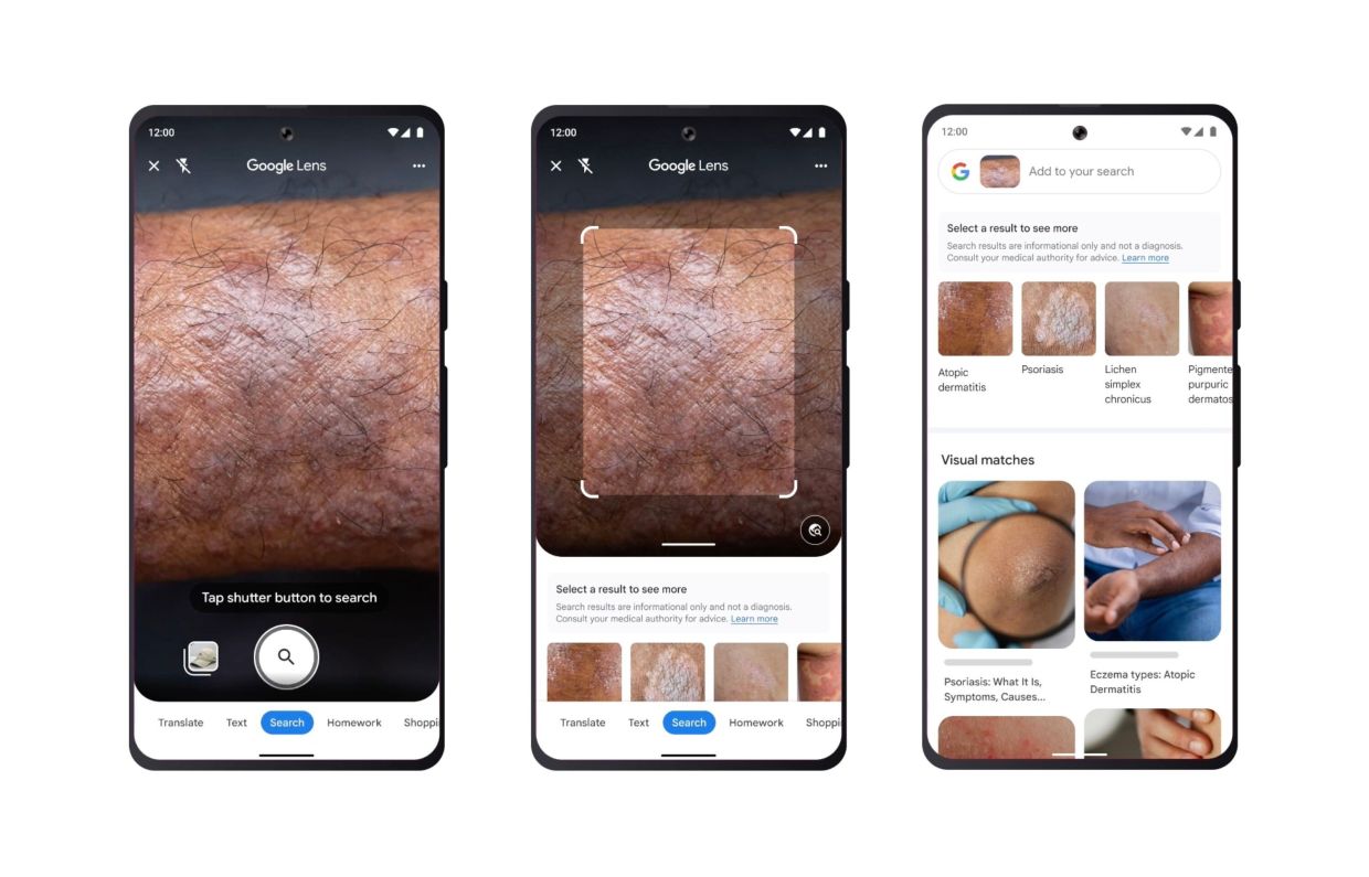Google Lens Kini Bisa Deteksi Penyakit Kulit Pakai AI, Begini Caranya ... Google Lens Kini Bisa Deteksi Penyakit Kulit Pakai AI, Begini Caranya ...